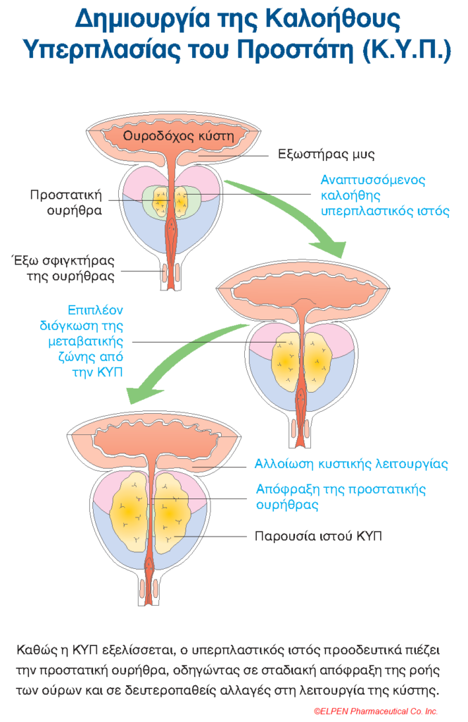 Παθήσεις του προστάτη | ΟΥΡΟΛΟΓΟΣ ΜΑΡΟΥΣΙ | ΠΑΠΑΛΕΞΗΣ ΓΕΩΡΓΙΟΣ